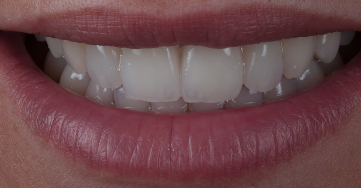 Dental News - Surface texture: Using horizontal and vertical lines to ...
