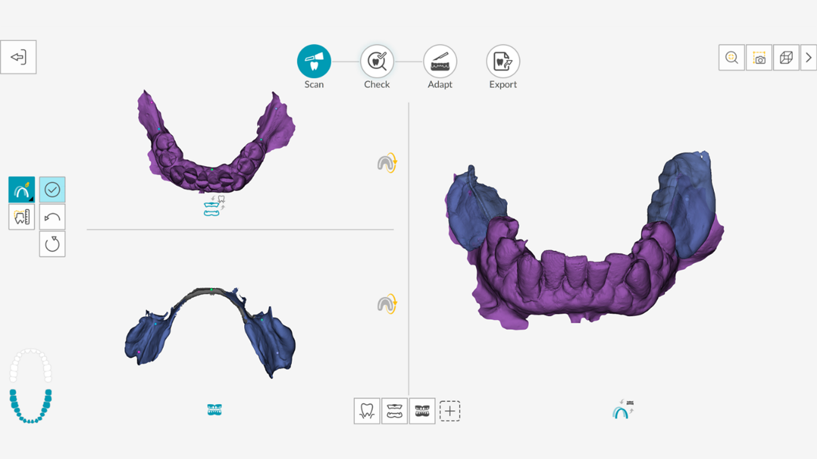 DEXIS intra-oral scanners with scan workflow for dentures