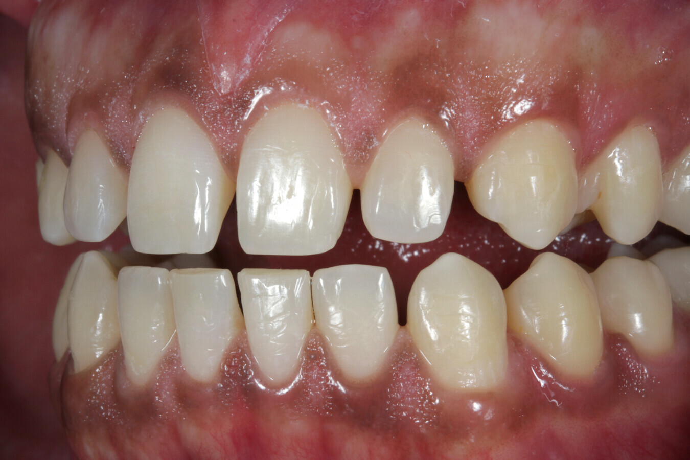 Veneer restoration: Calibrated preparation to close diastemas