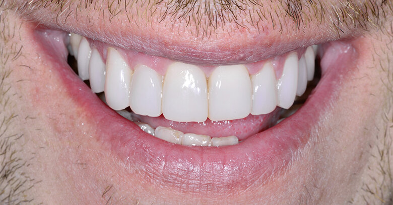 DT News - MEA - The next generation of the composite veneering system