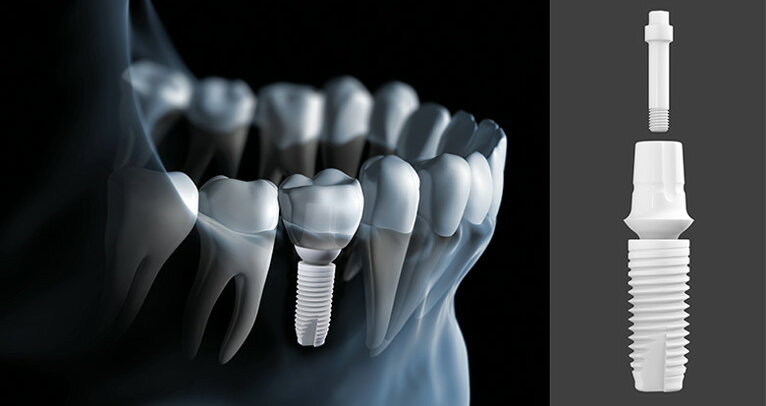 Ceramic implants: What benefits do they offer?