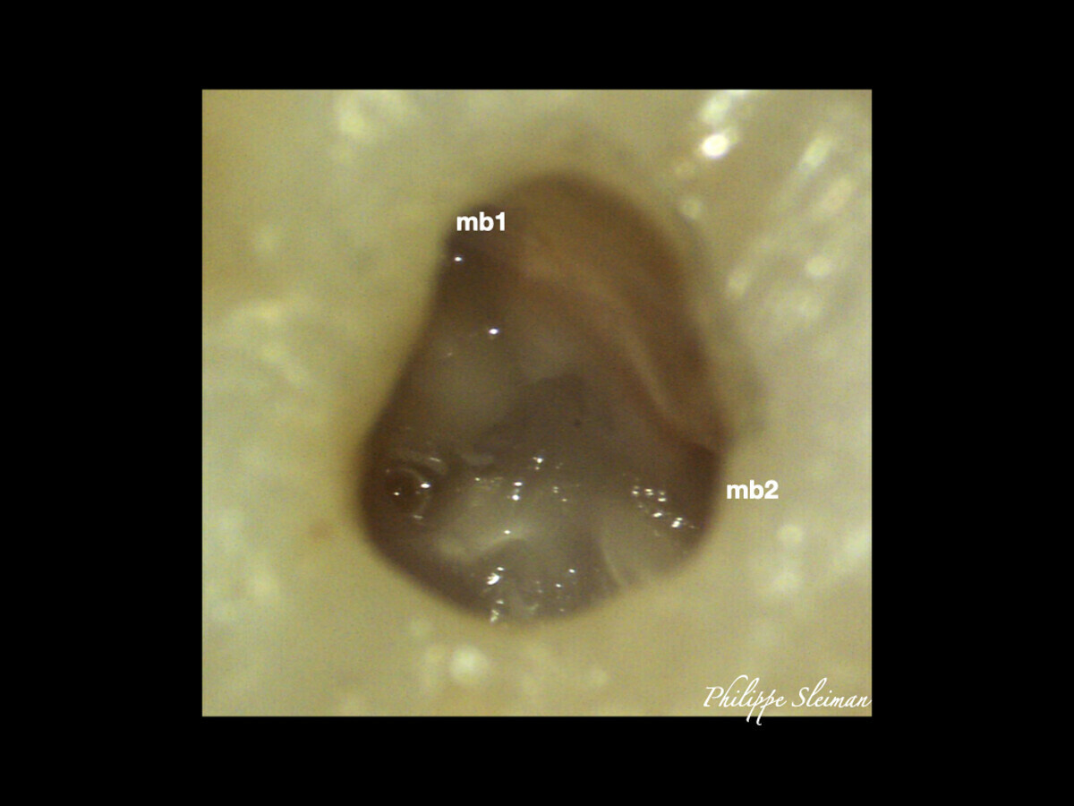 Clinical management of maxillary second molar root canal therapy in ...