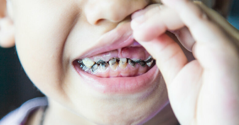 DT News - International - Duration of breastfeeding may impact dental ...