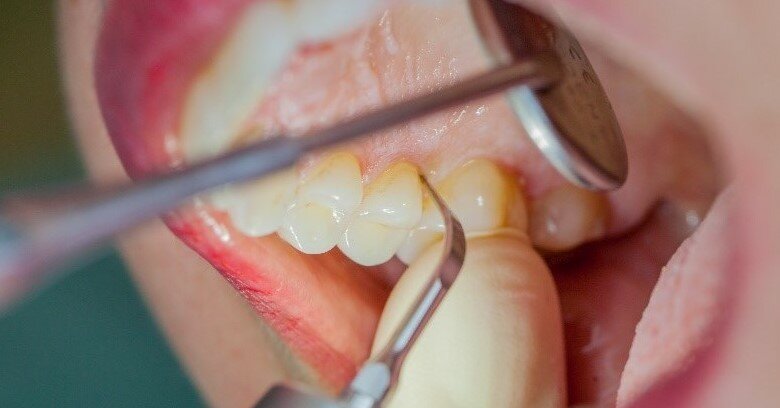 Dental News - Implants should only be inserted when periodontal ...