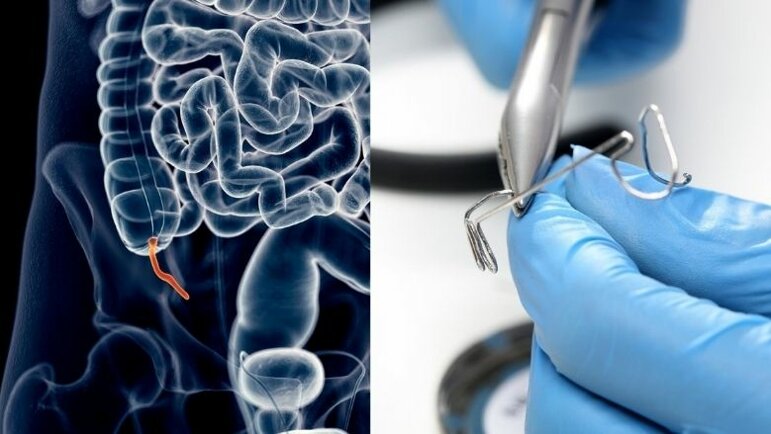 DT News - Netherlands - Blindedarmontsteking door orthodontische draad