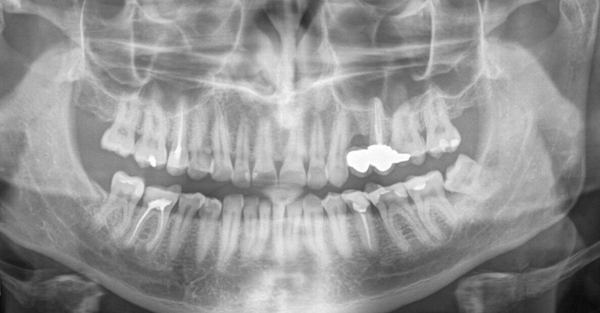 Endodontic treatment of maxillary left first molar