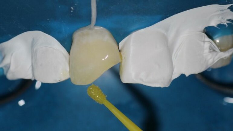 Developing tight proximal contacts in anterior teeth using Unica ...