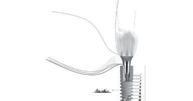 Dentsply Sirona – ANKYLOS