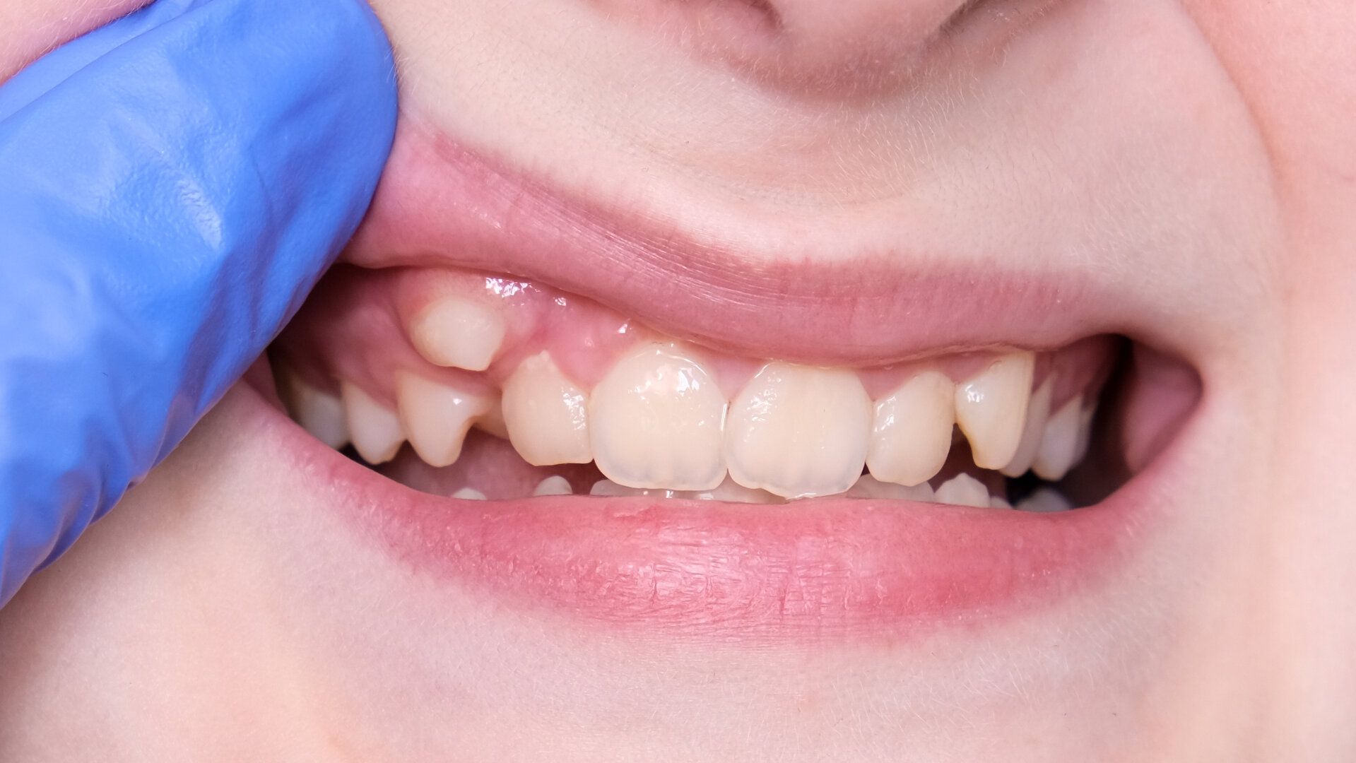 LightForce Orthodontics secures funding for 3D-printed brack