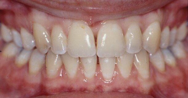 Dental News - Orthognathic surgery and recovery have different ...