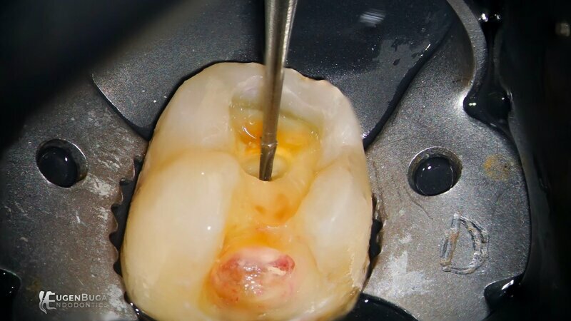 Guide to achieving fast and efficient precision in endodontics