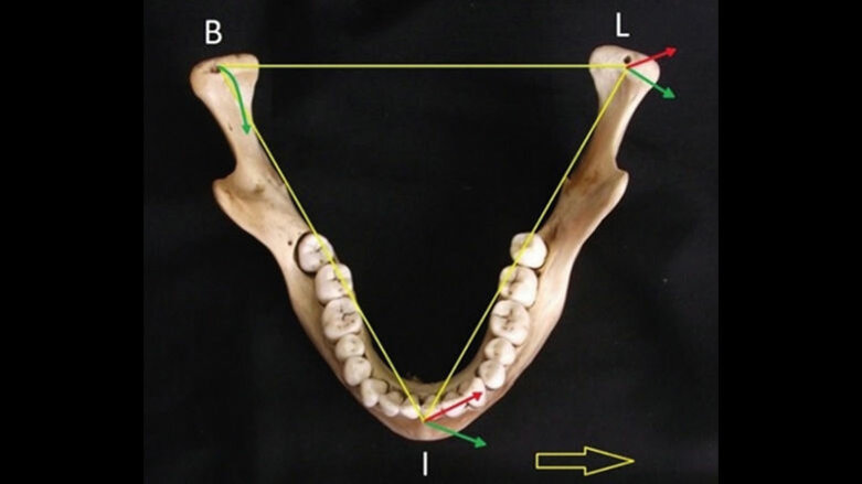 Condylar retrusion on the horizontal plane associated with retrusive ...