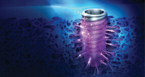 Dental News - Aesthetics reimagined with INVERTA implant