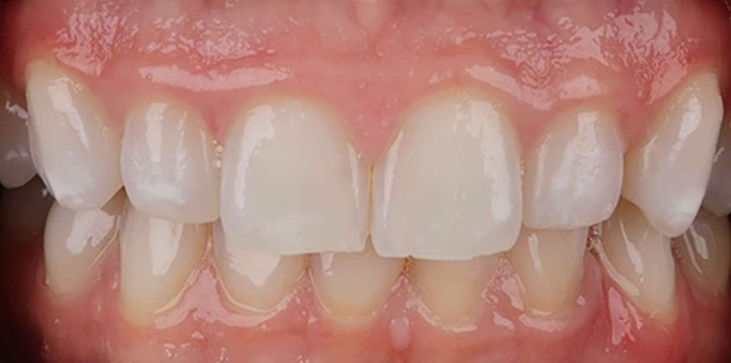DT News - International - Conservative aesthetic management of white ...