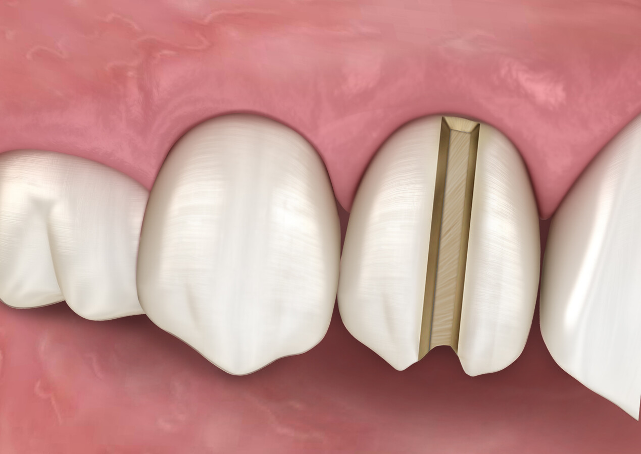 Eliminating the challenges of crown removal or endodontic access ...