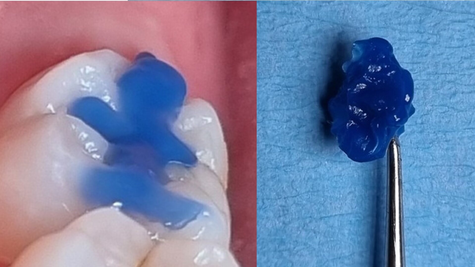 The stamp technique: Quick and effective restoration with glass hybrids