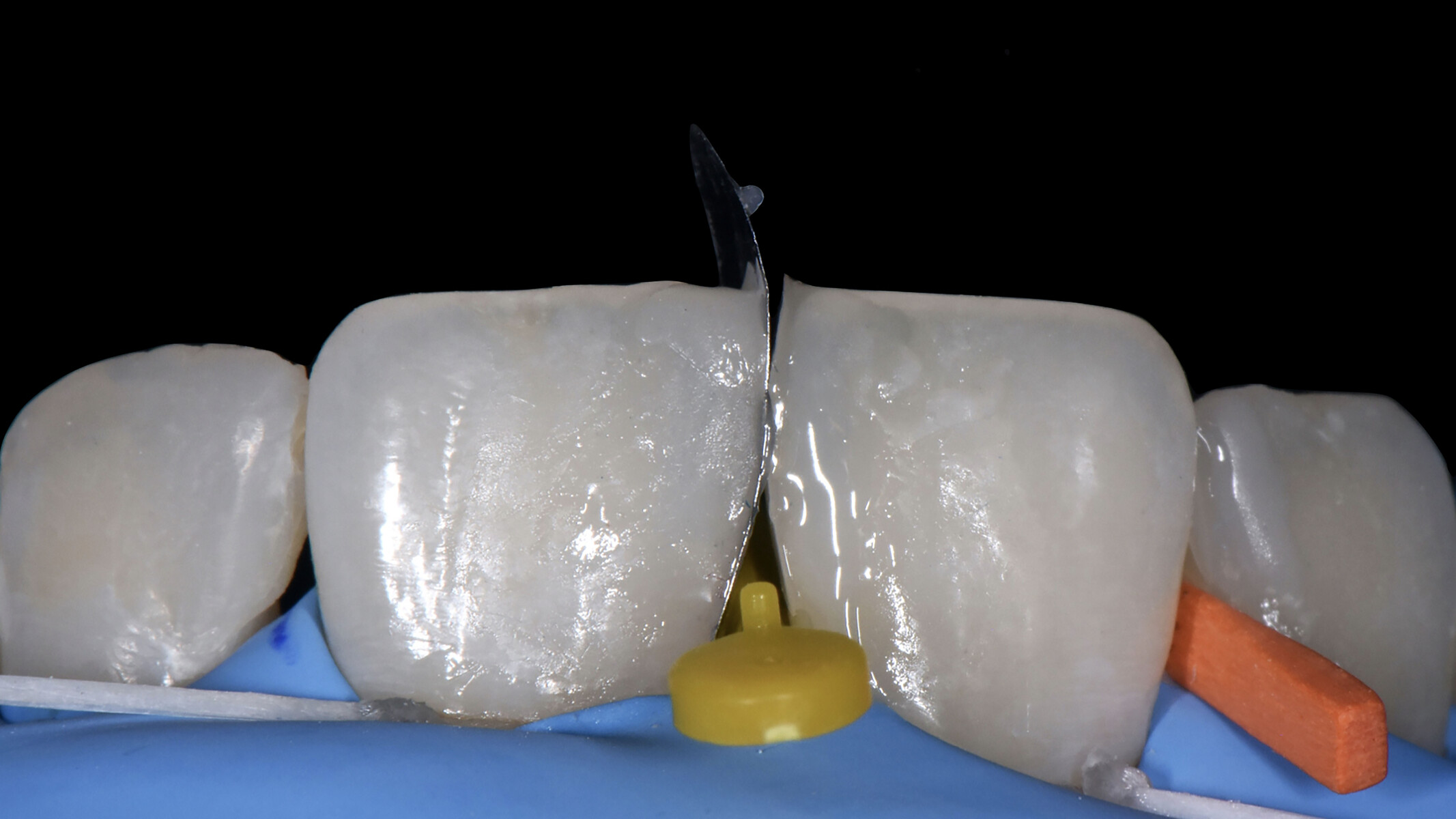 Diastema closure using a direct two-matrix technique