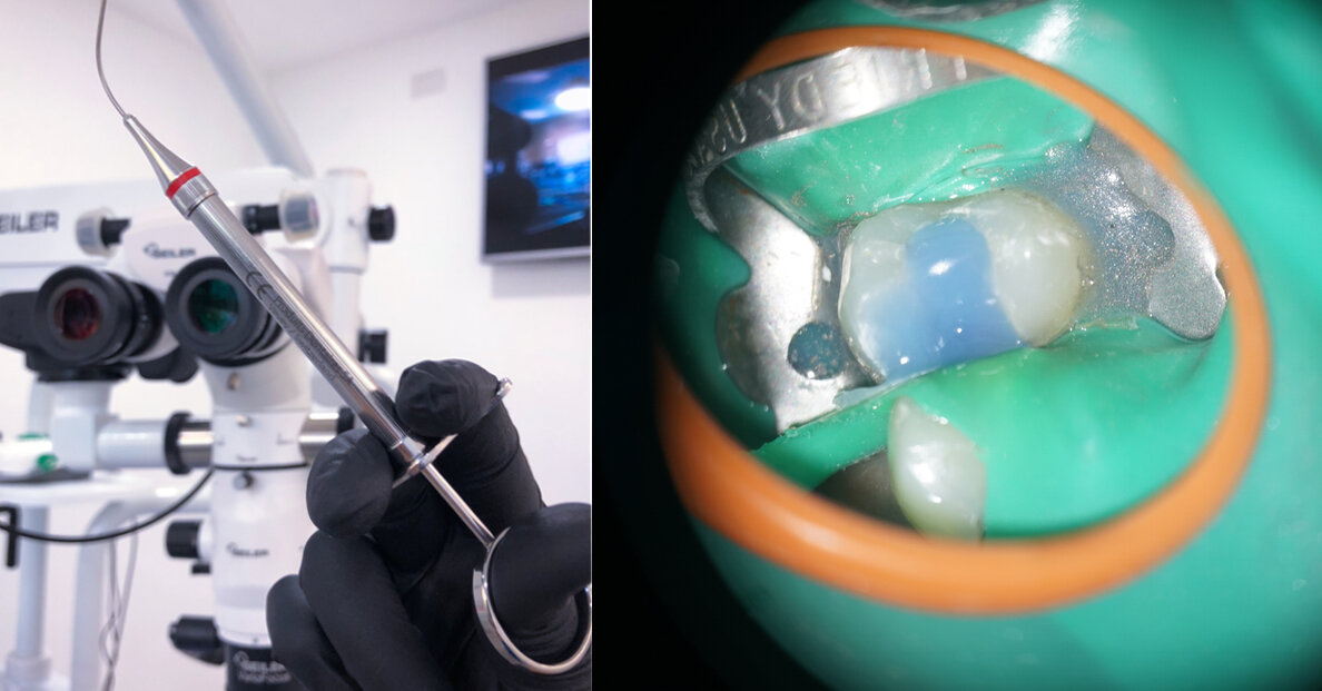 Dental News - Direct pulp capping as a conservative procedure to ...