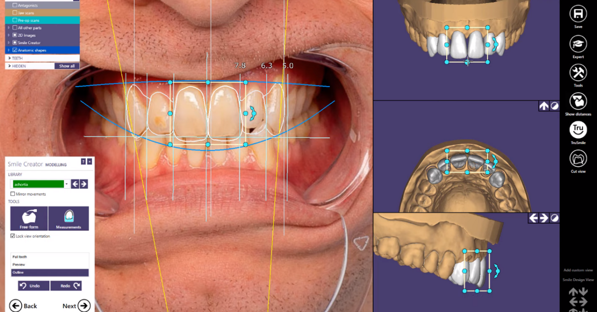 exocad Quick Guide: Get the most out of your Smile Creator Module!