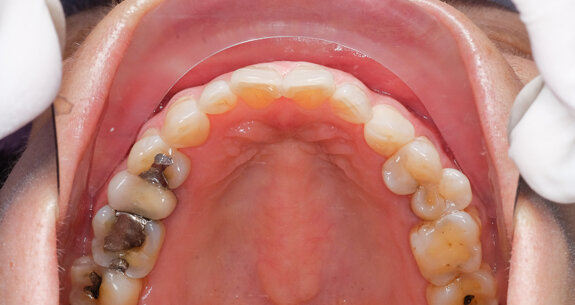 Study reveals environmental impact of dental amalgam