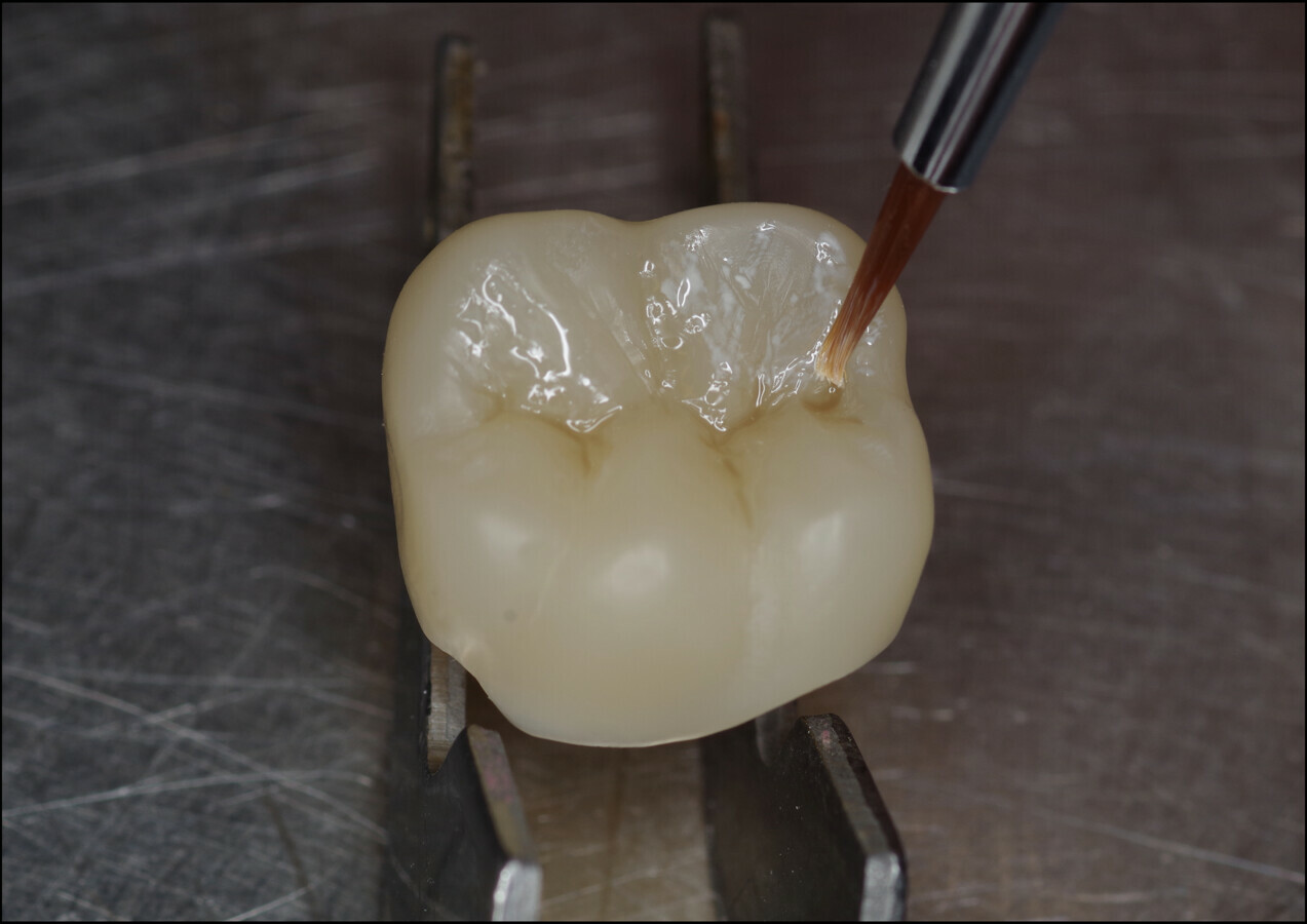 Chairside fabrication of an endocrown