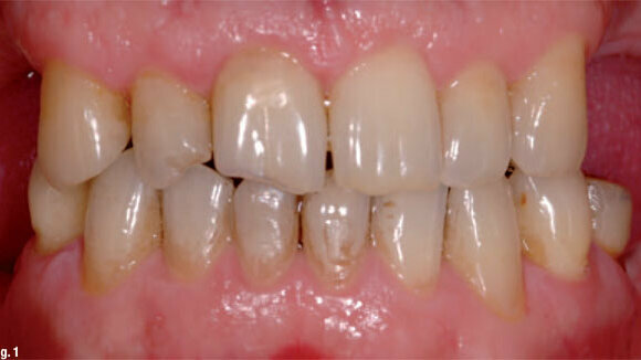 DT News - International - Fixed prosthodontic management of a mutilated ...