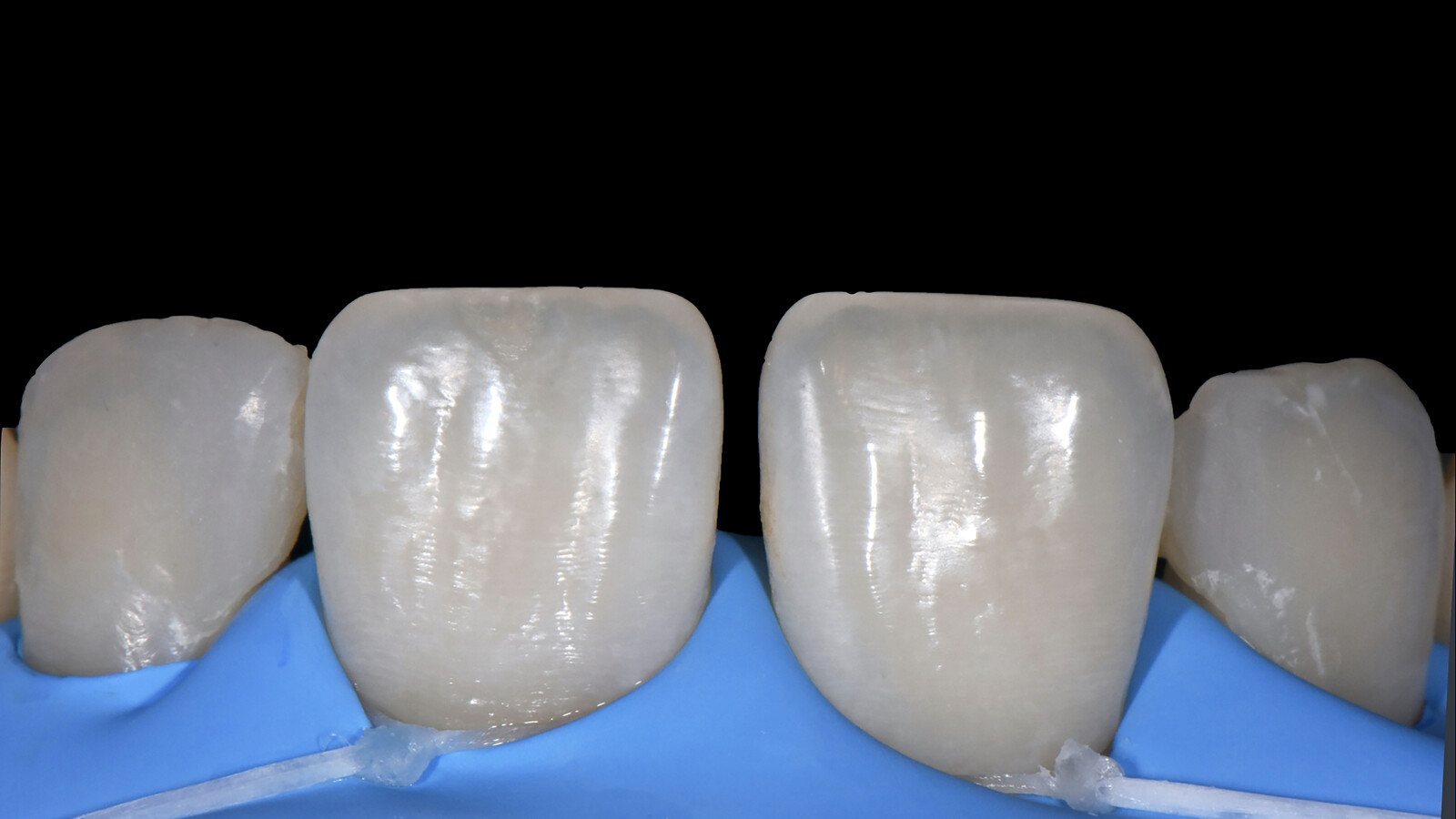 Diastema closure using a direct two-matrix technique