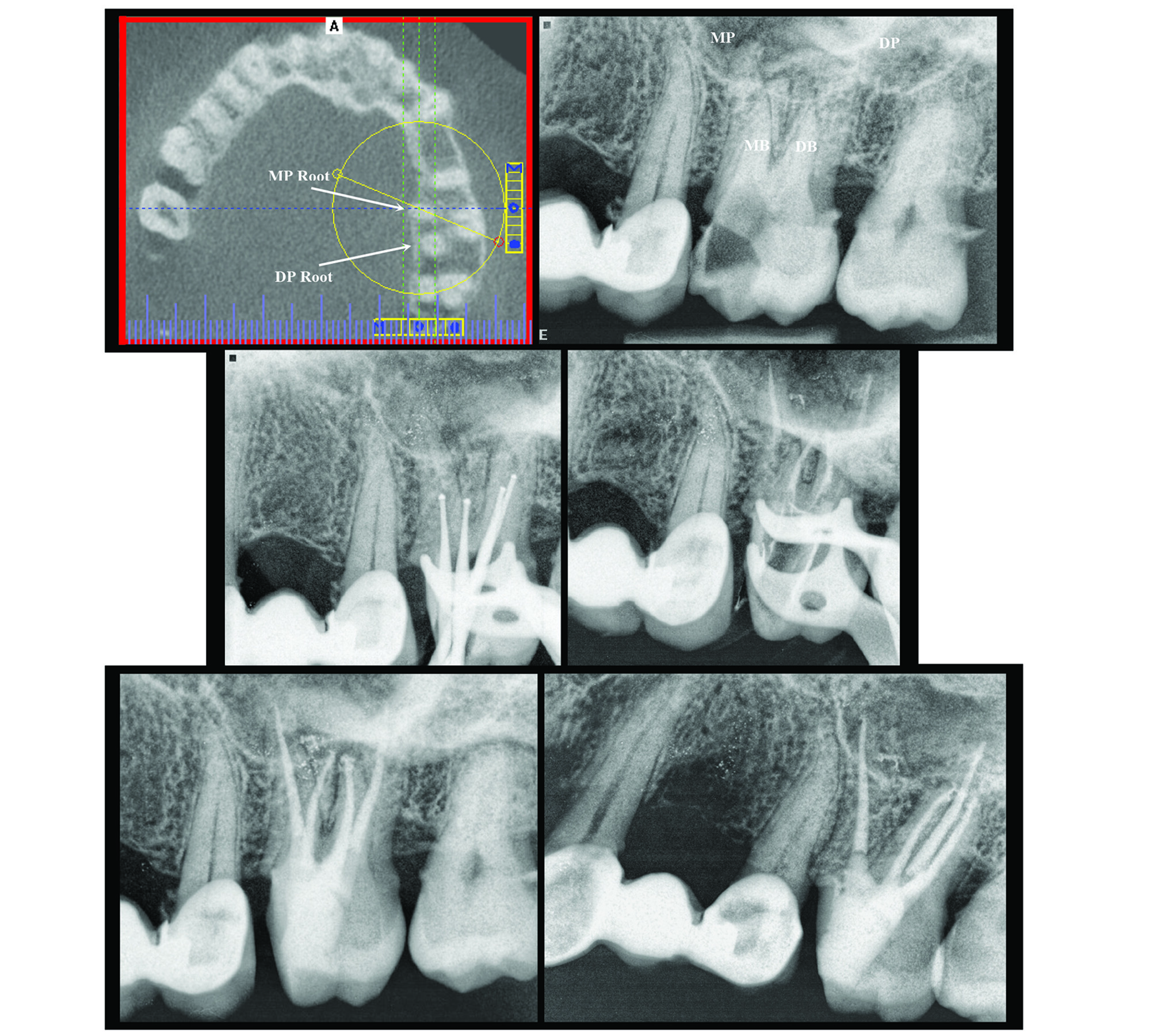 Dental News - Using pre-endodontic bonded buildup to manage isolation ...