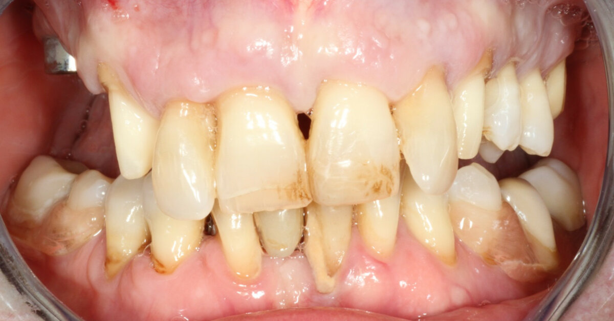 Dt News International Partial Extraction Therapy And Implant Treatment In The Maxilla