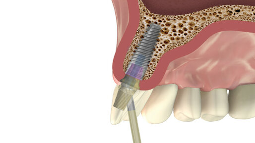 Dental News - MIS releases new EZ-Base abutment