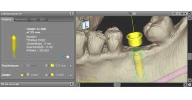 Neodent implant library now available in coDiagnostiX Guided Surgery ...