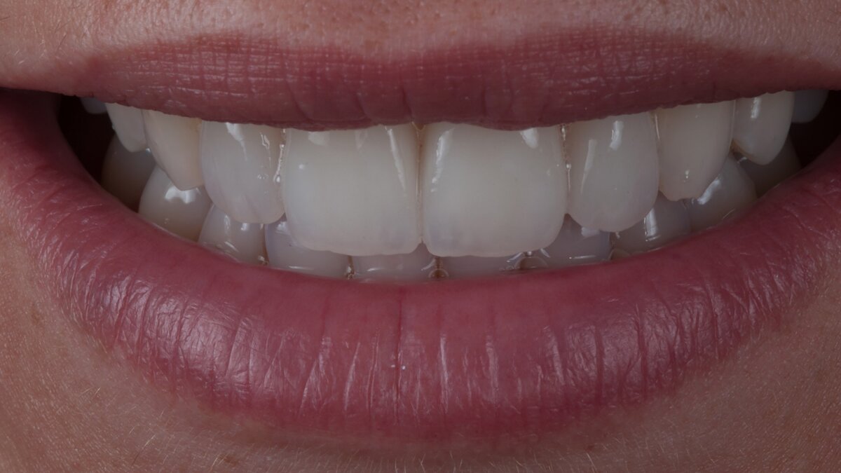Dental News - Surface texture: Using horizontal and vertical lines to ...
