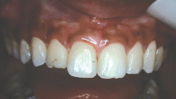 Dental News - ‘Growing Enamel’ — Revisited