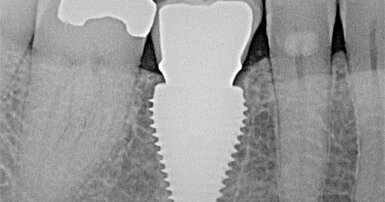 MAX ultra wide platform implants