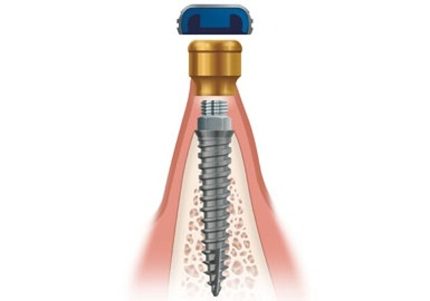 ZEST Anchors introduces a new narrow-diameter implant system featuring ...