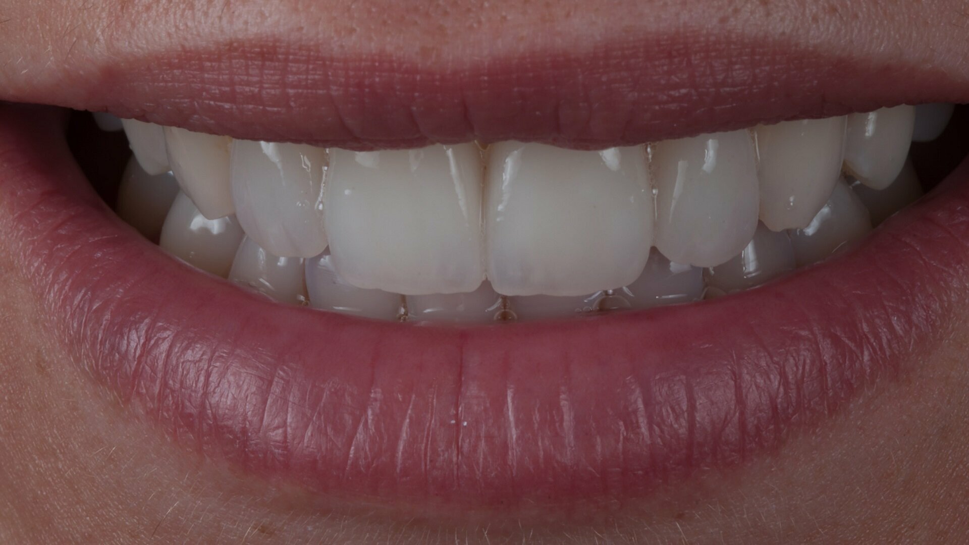 Dental News - Surface texture: Using horizontal and vertical lines to ...