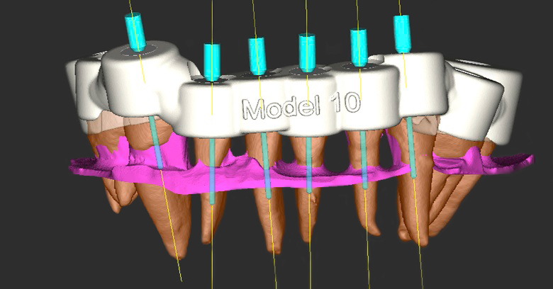 Research team receive multiple awards for micro-guided endodontics ...