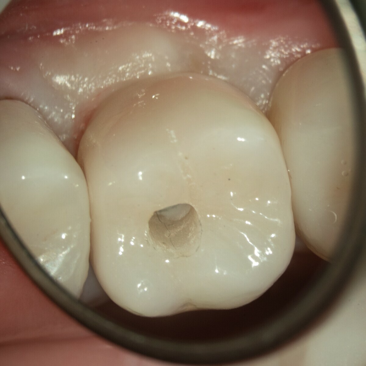 The transparent gingiva project IV