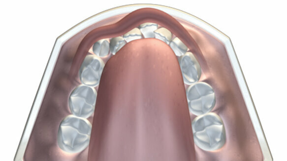 Myofunctional orthodontics and myofunctional therapy