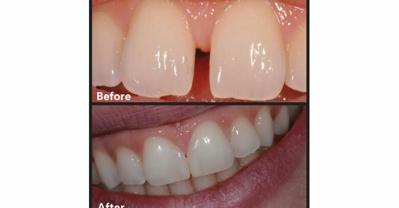 DT News - MEA - Midline diastema closure using the front wing technique