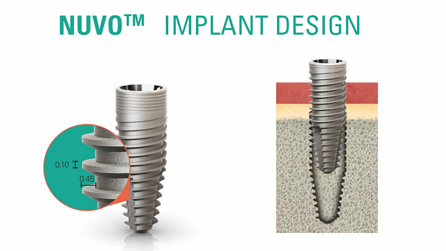 DT News - MEA - Tapered Implants: Designing original to boost primer ...