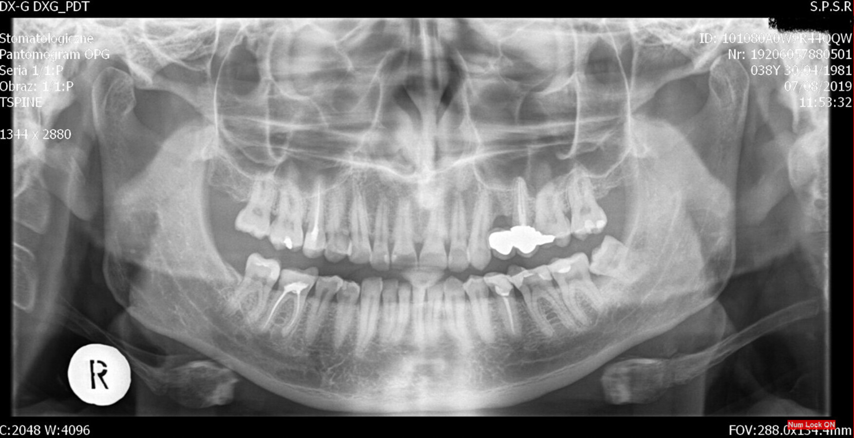 Endodontic treatment of maxillary left rst molar with complicated root ...