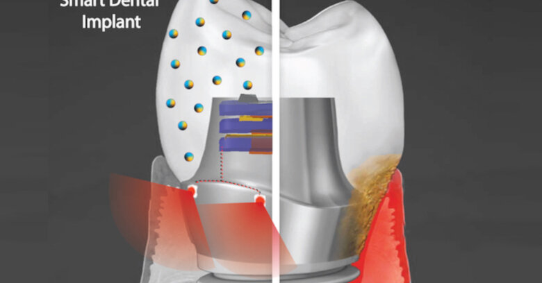 Researchers developing antibacterial smart dental implant