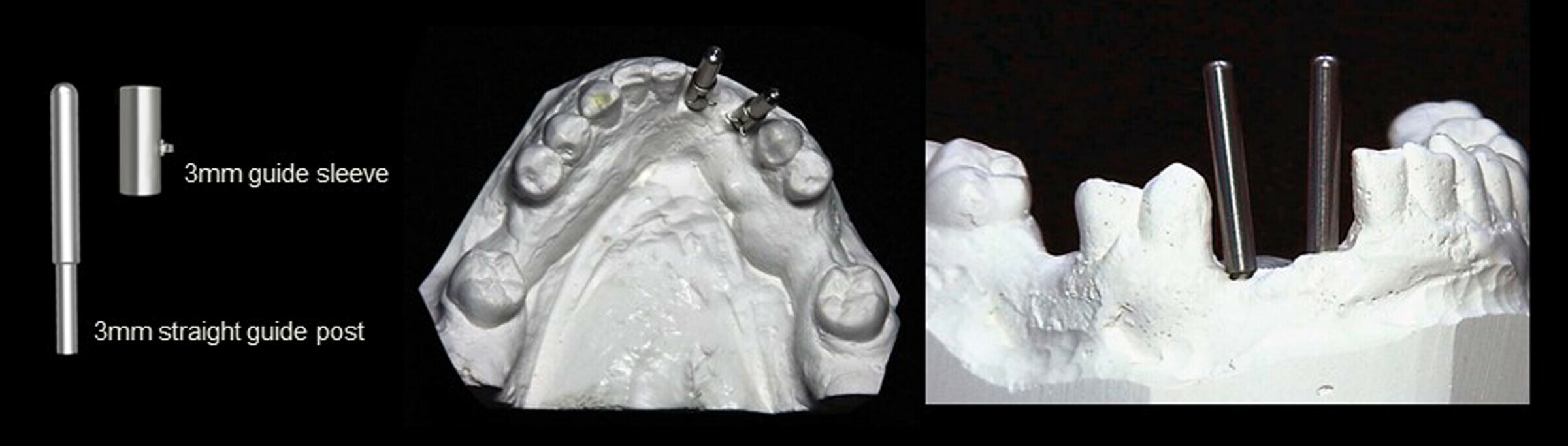 An in-office-fabricated implant surgical guide corrected using CBCT