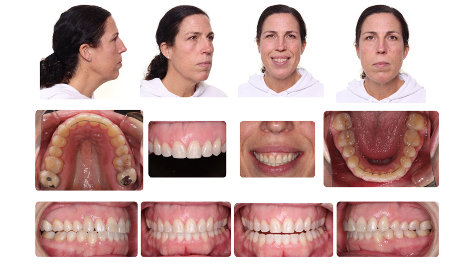 Dental News - Case study: Class I crowded malocclusion with moderate ...