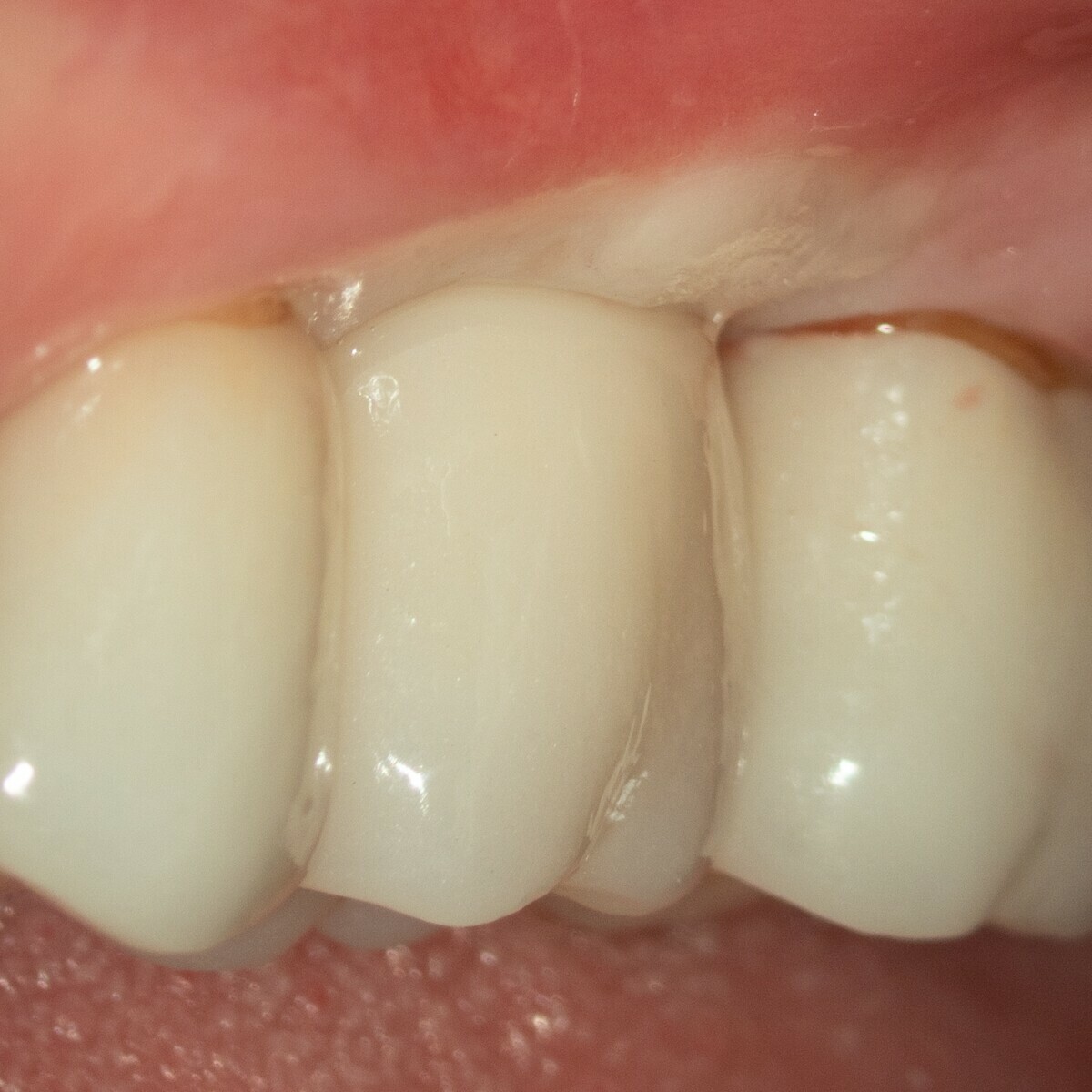 The transparent gingiva project IV