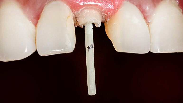 CAD/CAM-integrated glass fibre post and core restoration improves tooth ...