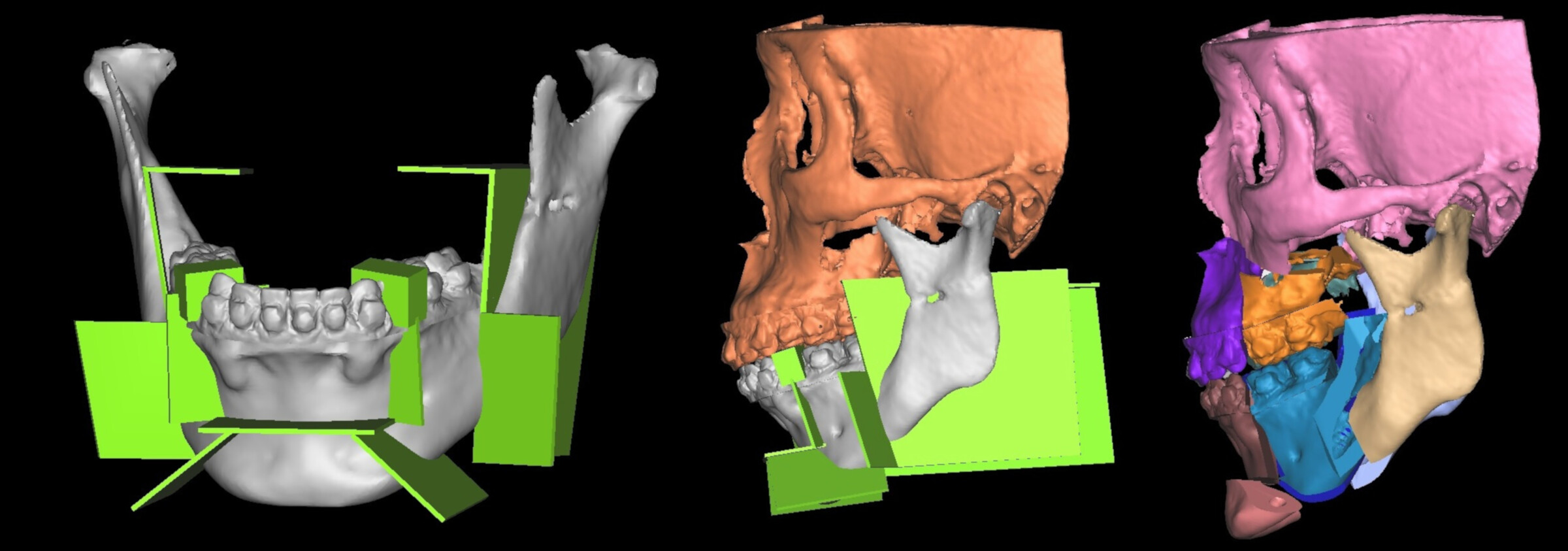 Dental News - Novel application of jaw advancement surgery helps treat ...