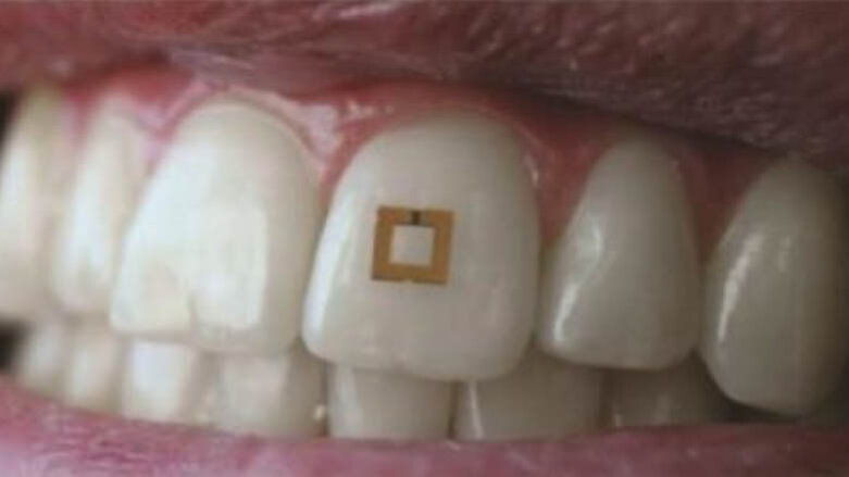 Dental News - New tooth-mounted microchip tracks ingested food
