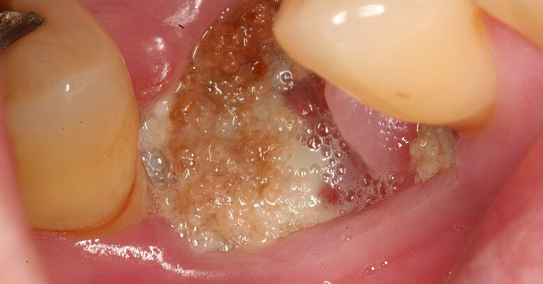Case study presents new treatment for jaw osteonecrosis